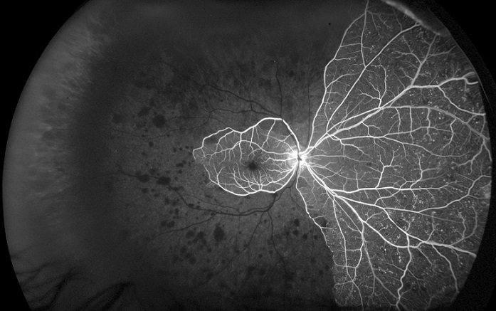 L'angiographie à la fluorescéine
